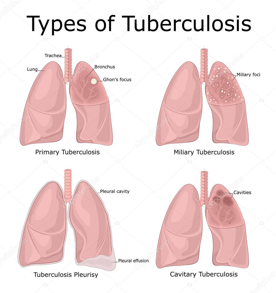 Ilustración de diferentes tipos de tuberculosis: primaria, miliar ...
