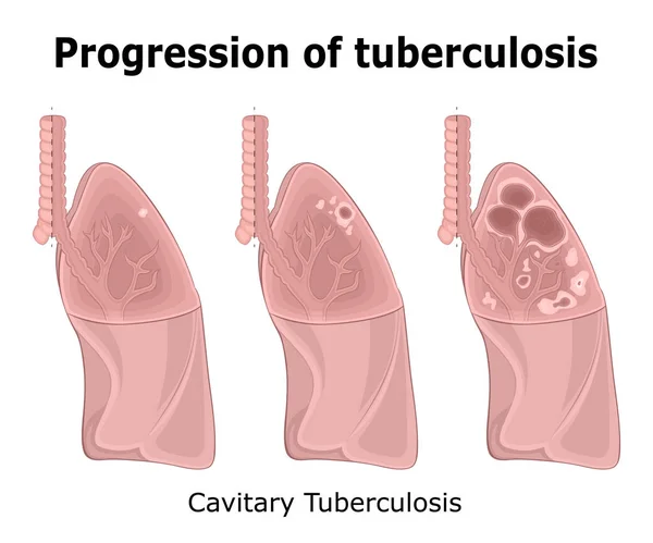 Ilustración de la progresión de la tuberculosis pulmonar cavitaria 2024