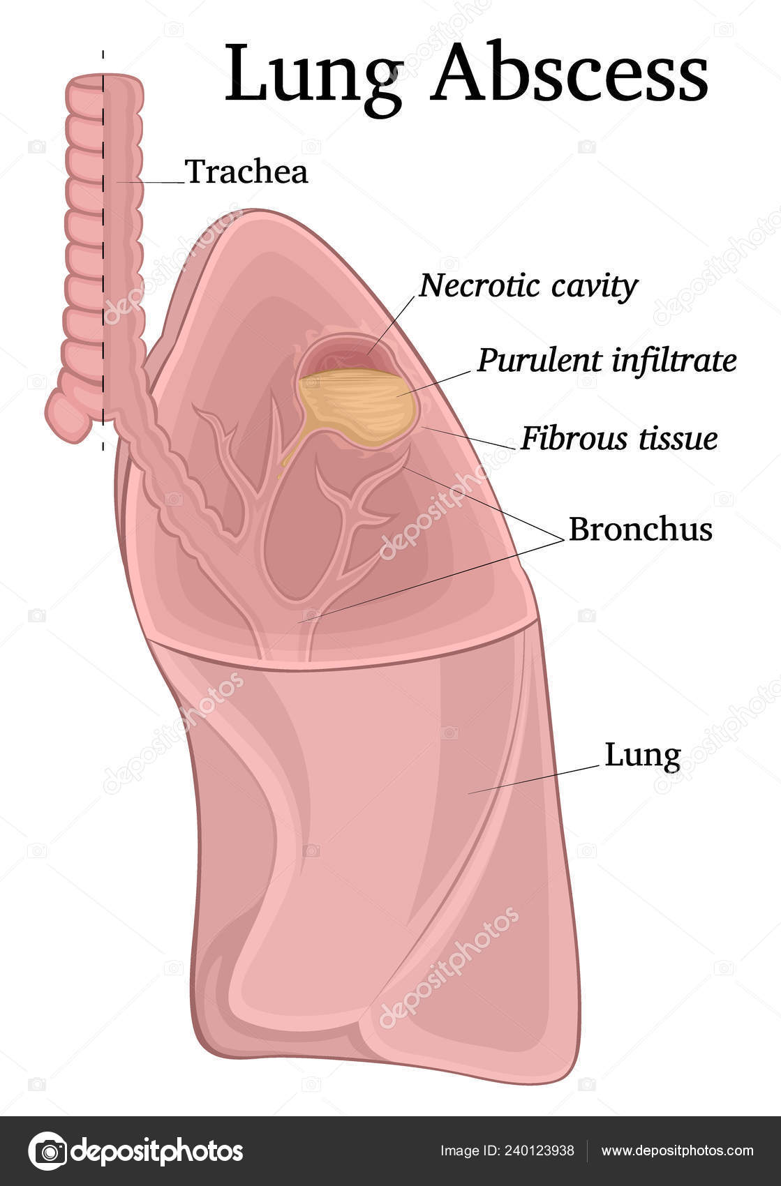 Ilustração Uns Pulmões Seccionados Que Retratam Uma Cavidade Purulenta ...