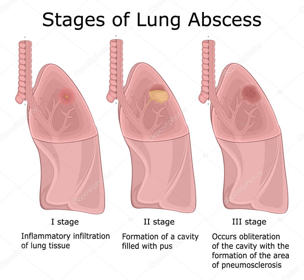 Ilustración de las tres etapas de la enfermedad pulmonar - Absceso ...