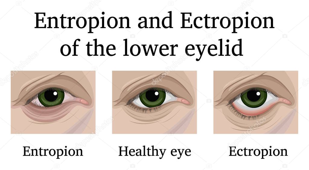 Vettoriale stockIllustrazione Delle Malattie Oftalmiche Entropia ...