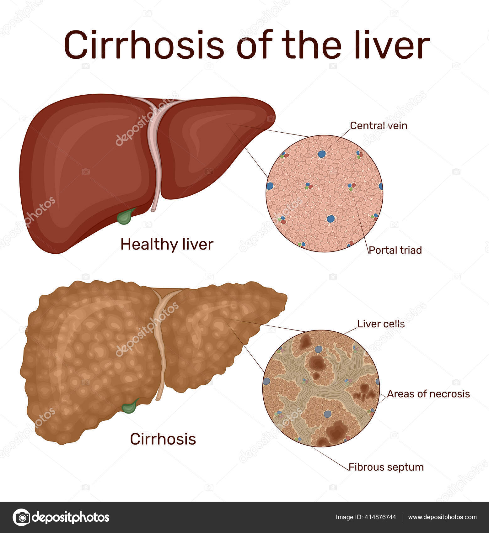 Cirrosis Del Higado Vs Higado Sano