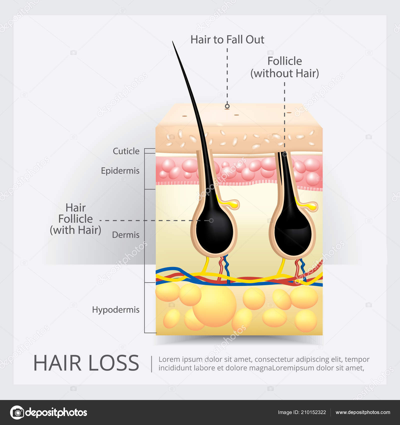 Ilustrasi Vektor Struktur Rambut Ingrown Vektor Stok oleh ...