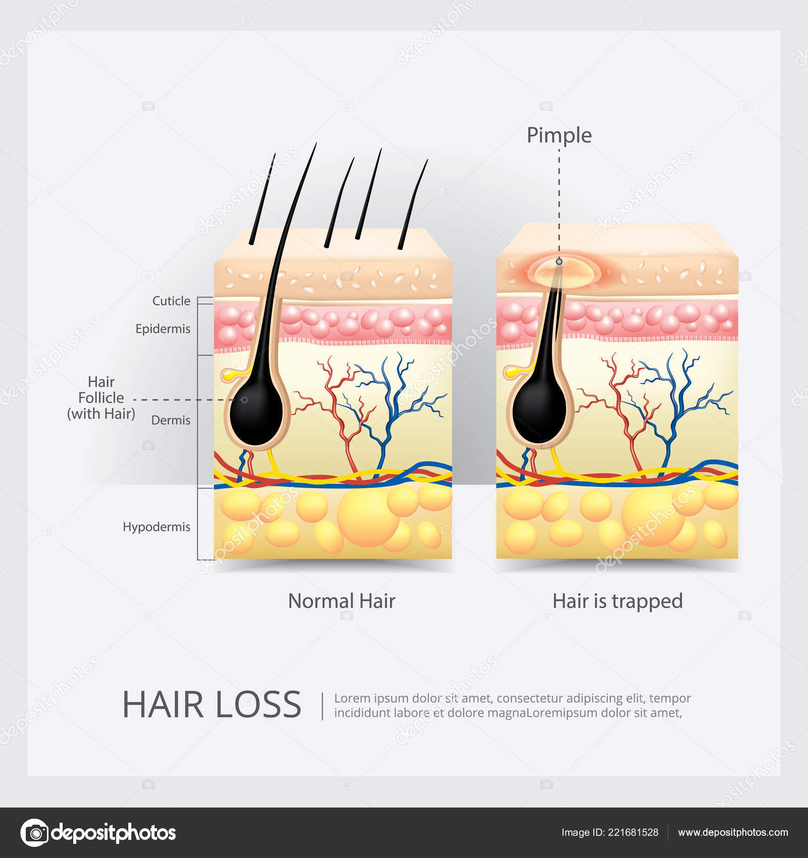 Ingrown Hair Structure Vector Illustration Stock Vector by ...