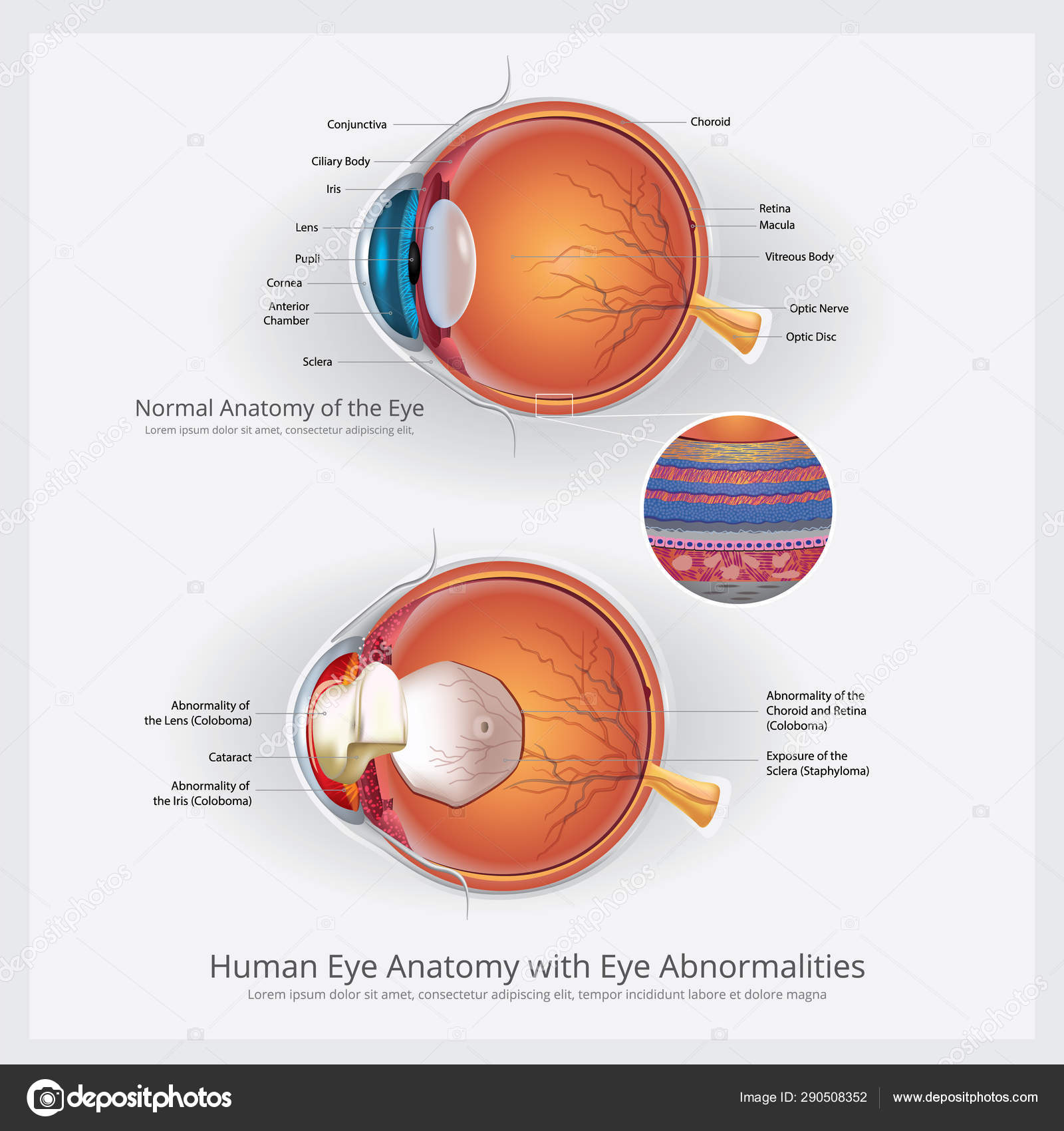 Eye Anatomy Eye Abnormalities Vector Illustration Stock Vector Image by ...