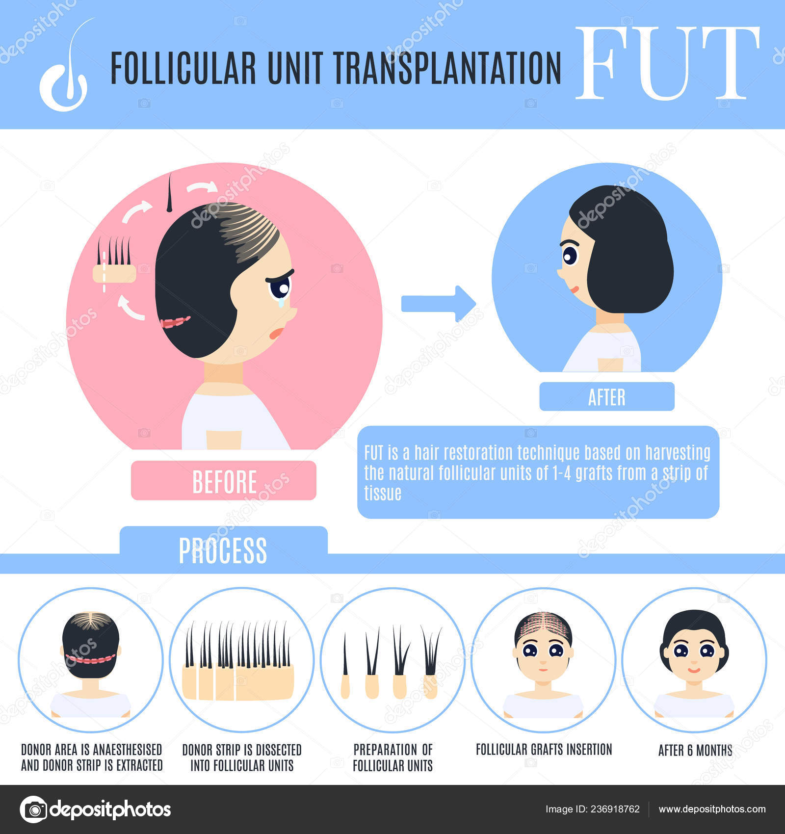 Follicular Unit Transplantation Female Hair Loss Treatment Infographics