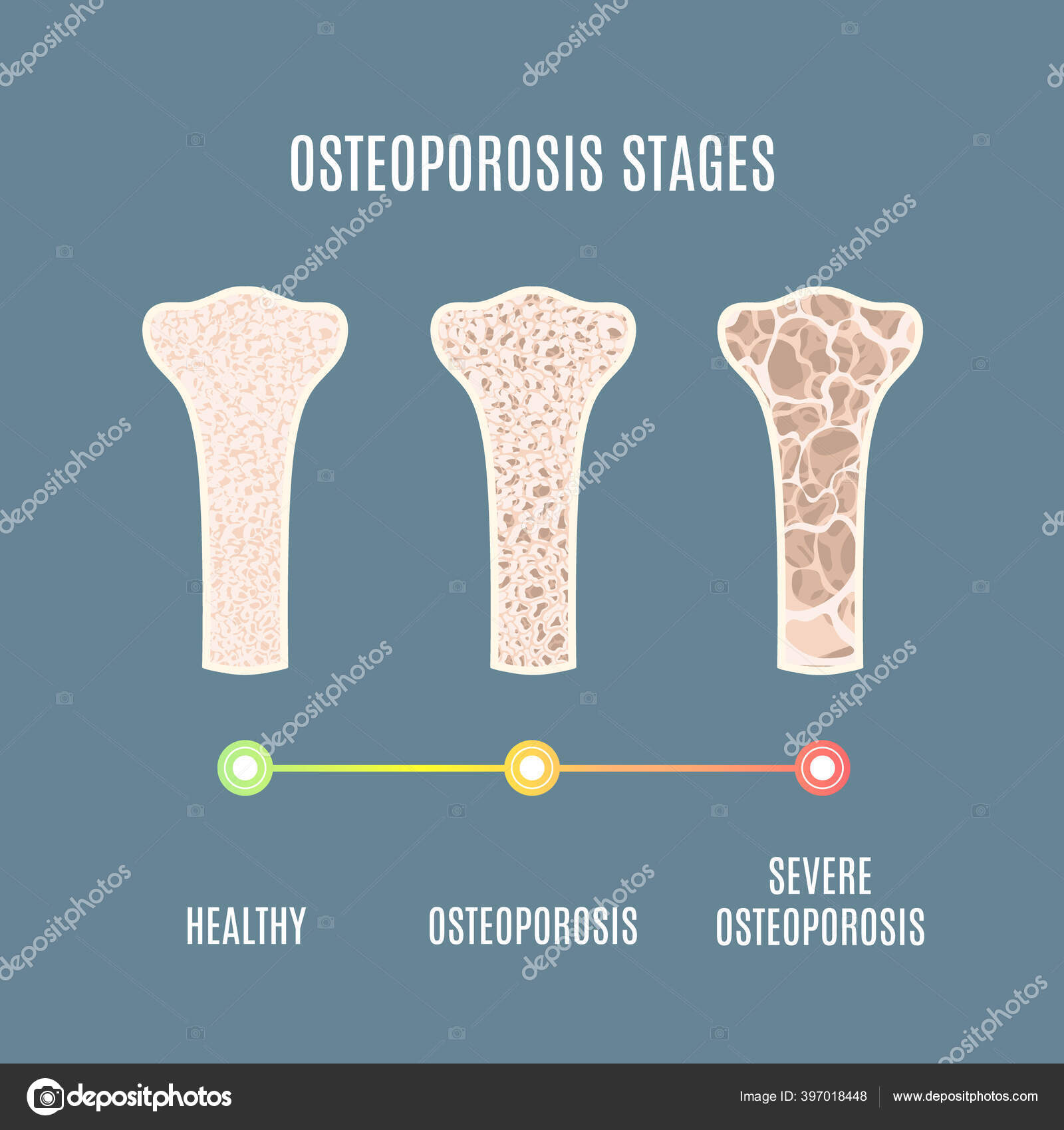 Osteoporose knogletæthed tab sygdom medicinsk infografik Stockvektor af ...