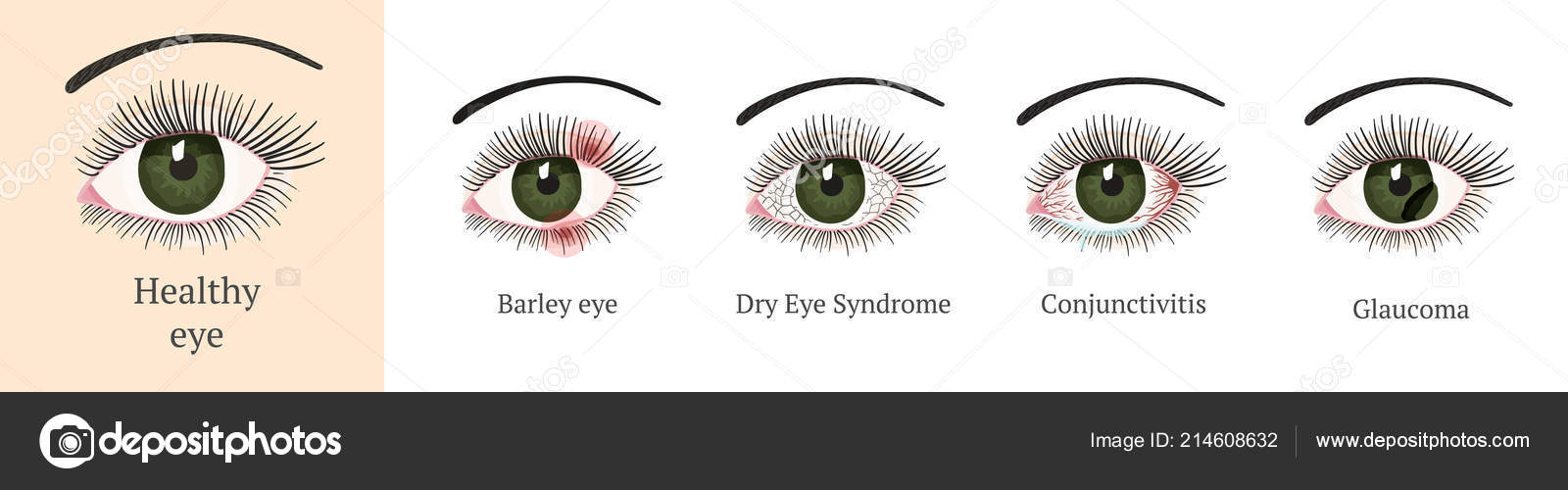 Most common eye problems Stock Vector by ©trihubova.gmail.com 214608632