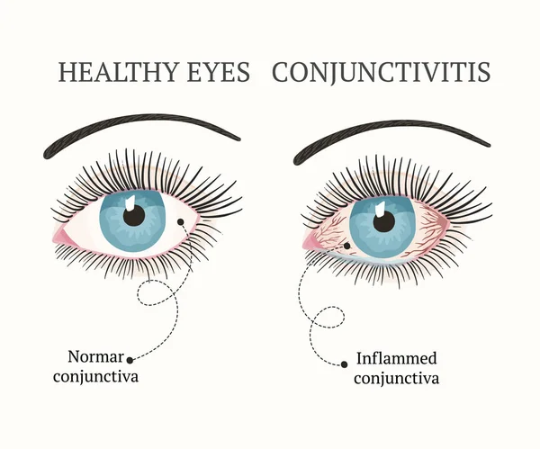 Conjunctiva Vector Art Stock Images | Depositphotos