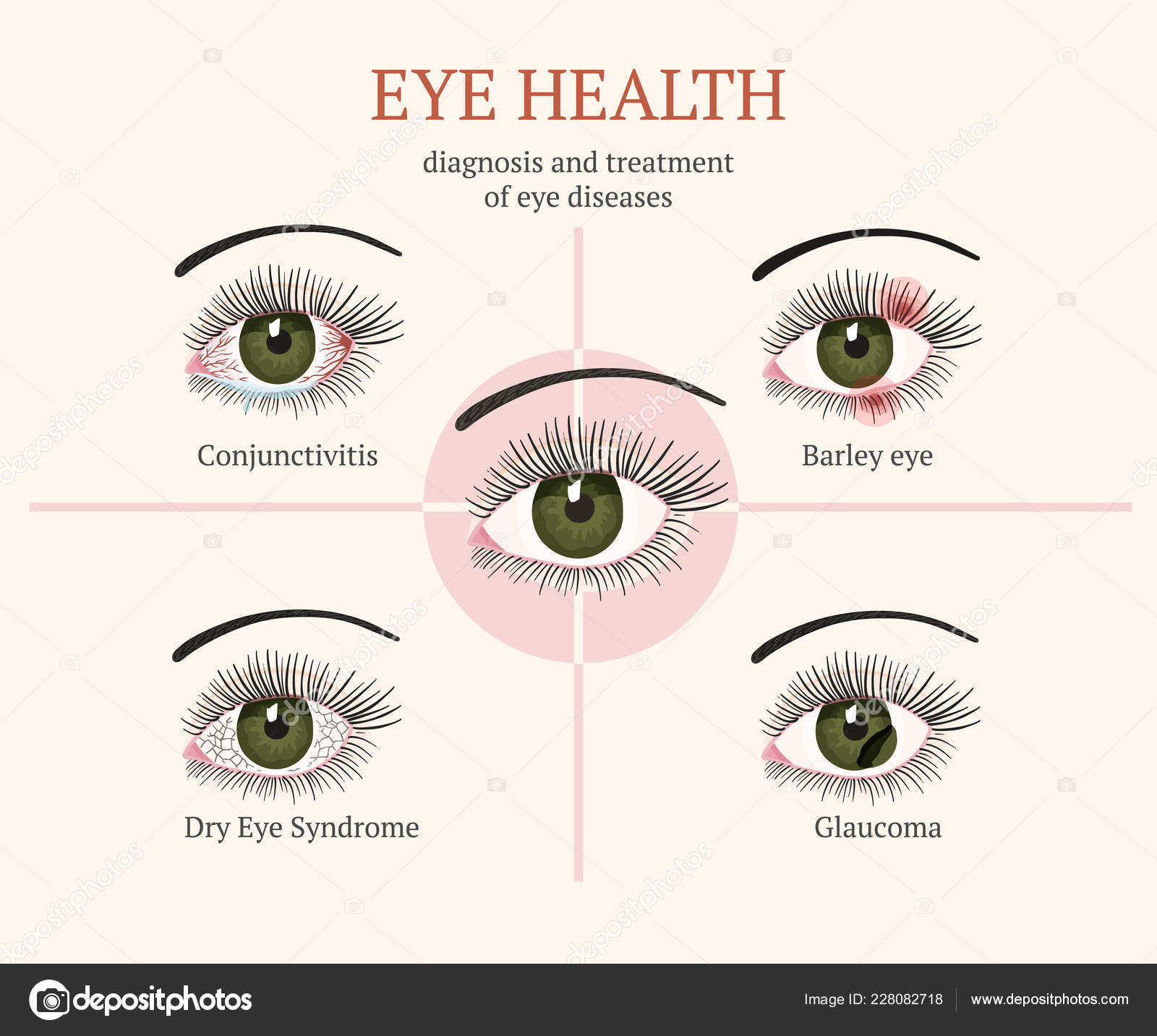 Most common eye problems. Stock Vector Image by ©trihubova.gmail.com ...