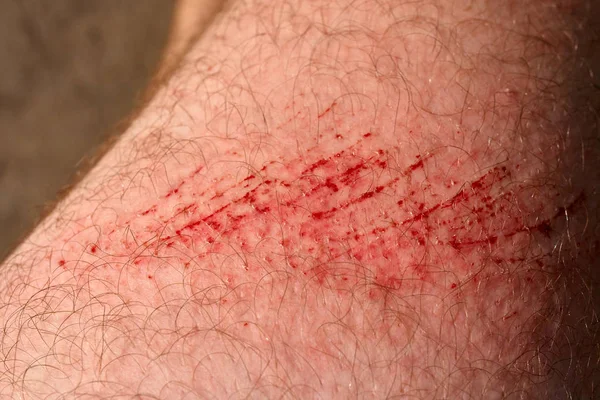 Deep Cut On Leg