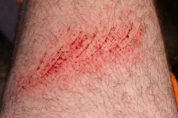 Rodilla raspada fotos de stock, imágenes de Rodilla raspada sin ...