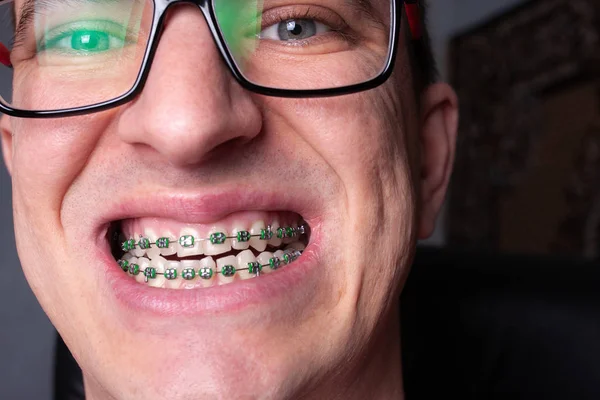 Crooked teeth — Stock Photo © vlue #4629372