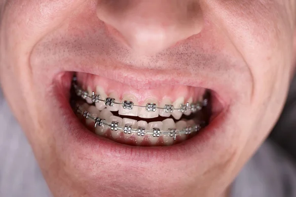 Grey Colored Braces
