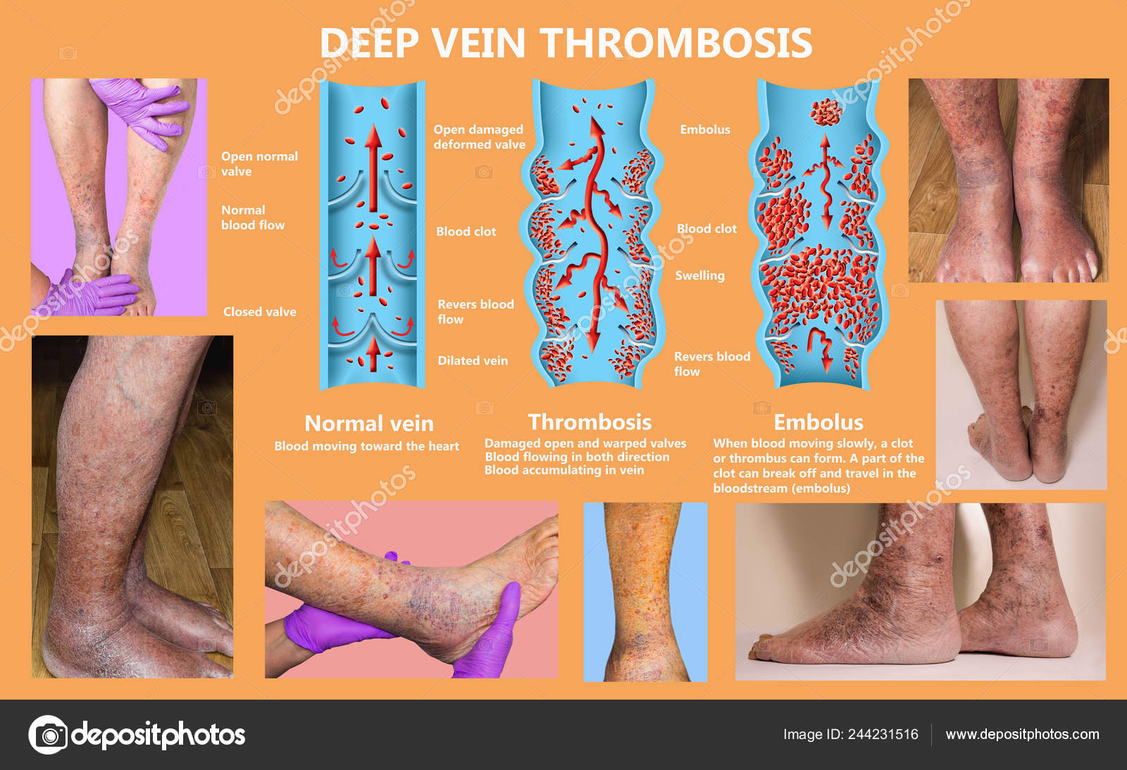 Economy class syndrome mechanism, deep vein thrombosis or DVT ...