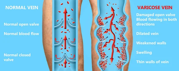 Varicose Veins Female Senior Legs Stages Varicose Veins Old Age — Stock ...