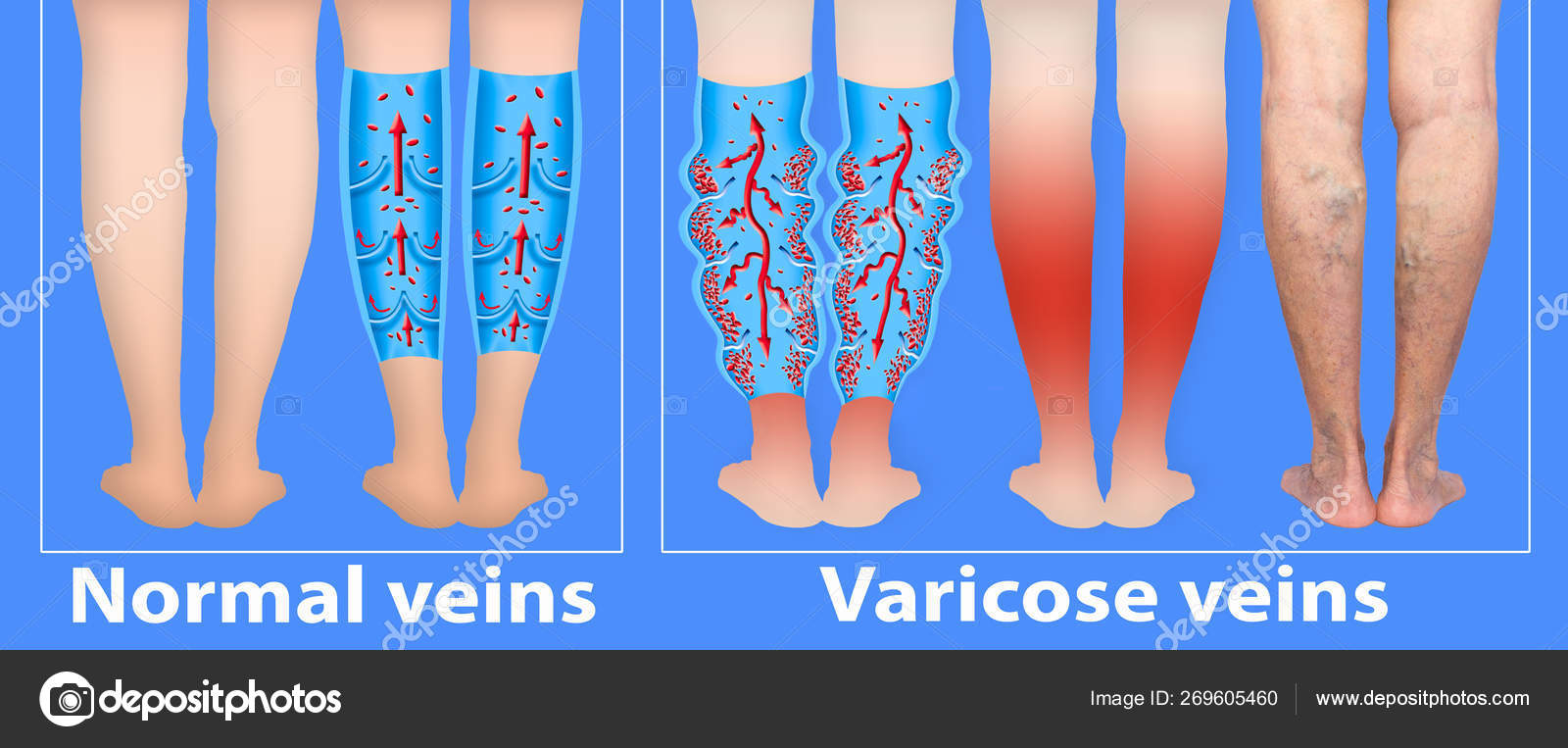 Veias varicosas em umas pernas seniores femininas. A estrutura das ...