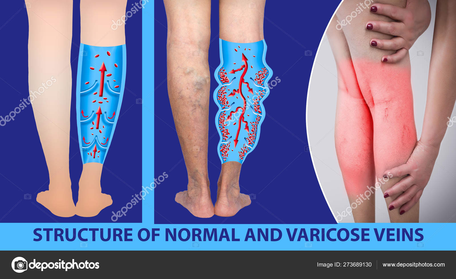 Vena Varicose pada kaki senior wanita. Struktur vena normal dan ...