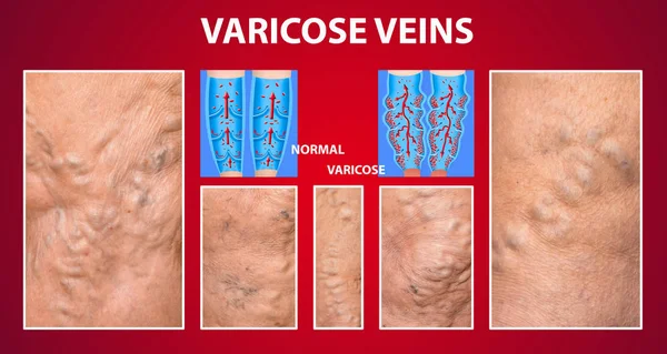 Varicose Veins Female Senior Legs Stages Varicose Veins Old Age — Stock ...