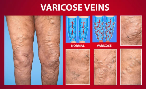 Varices sur les jambes d'une femme âgée. La structure des veines ...
