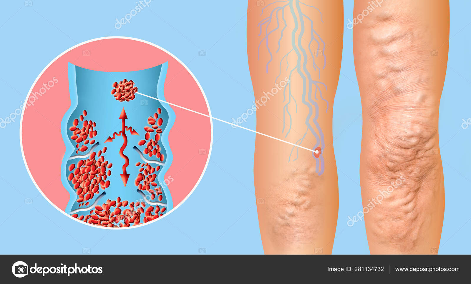 Deep Vein Thrombosis or Blood Clots. Embolus. Stock Photo by ©Marina113 ...