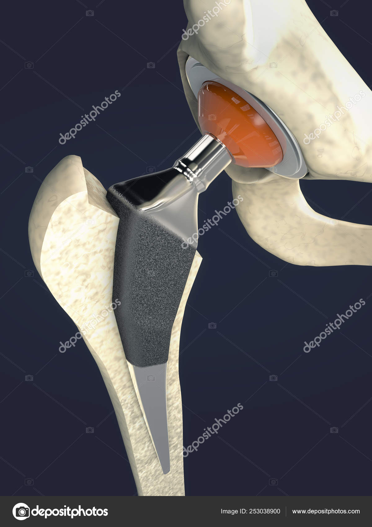 Function of a hip joint implant or hip prosthesis in frontal view - 3d ...