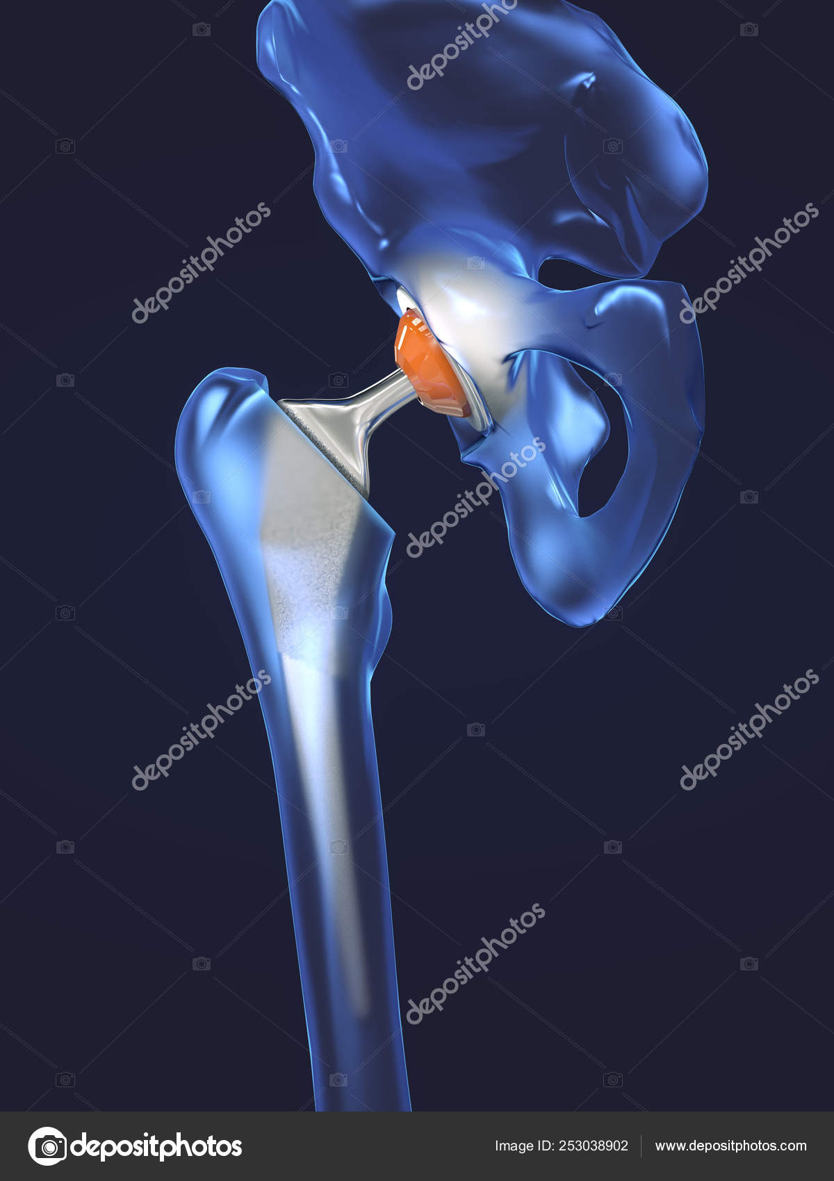 Function of a hip joint implant or hip prosthesis in frontal view - 3d ...