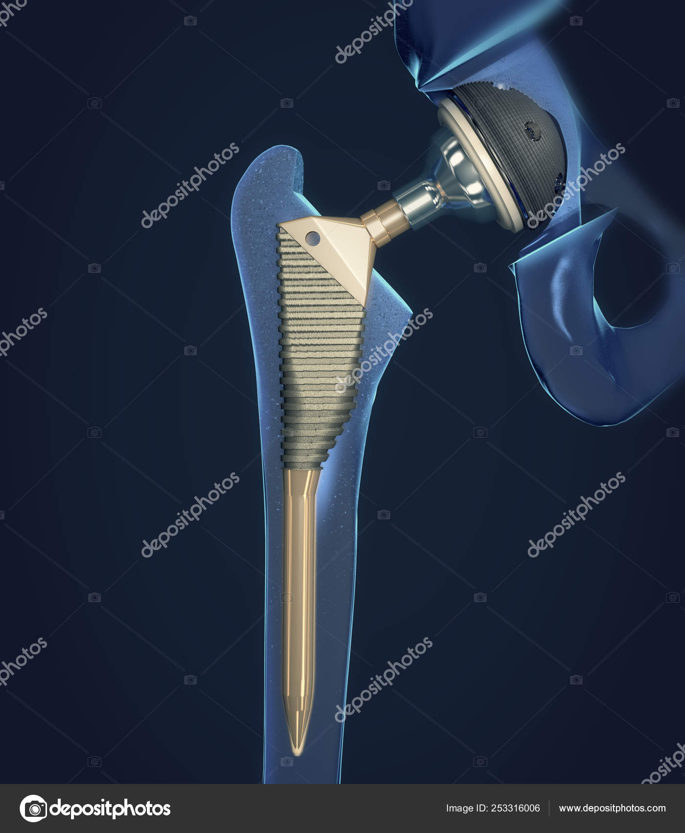 Function of a hip joint implant or hip prosthesis in frontal view - 3d ...