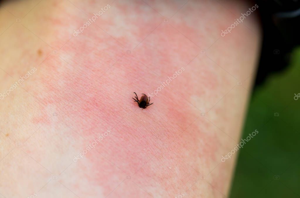 Irritación por la picadura. Enrojecimiento de la piel por una picadura ...