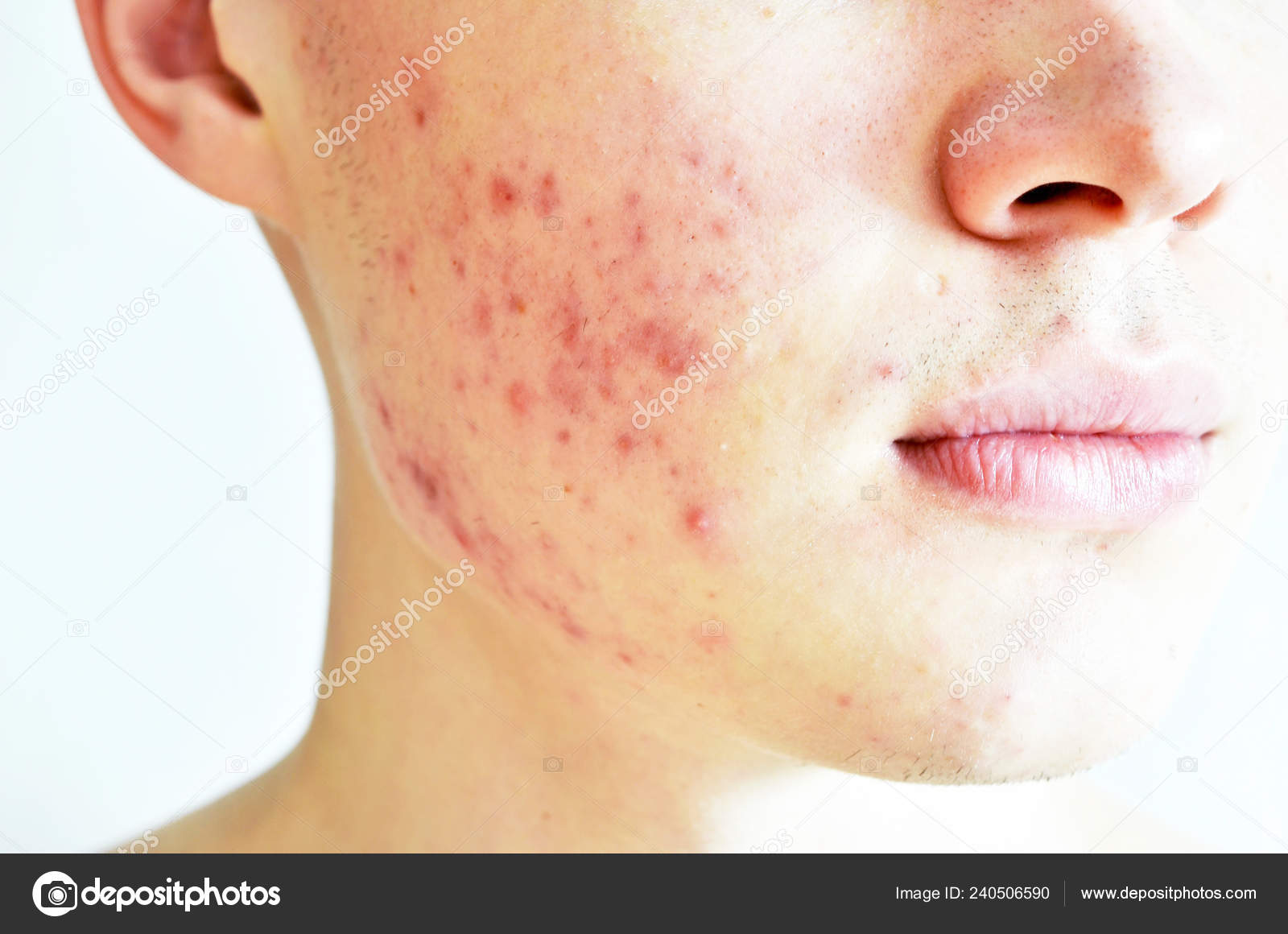 Close Man Problematic Skin Scars Acne Stock Photo by ©irinaantokolskaya ...