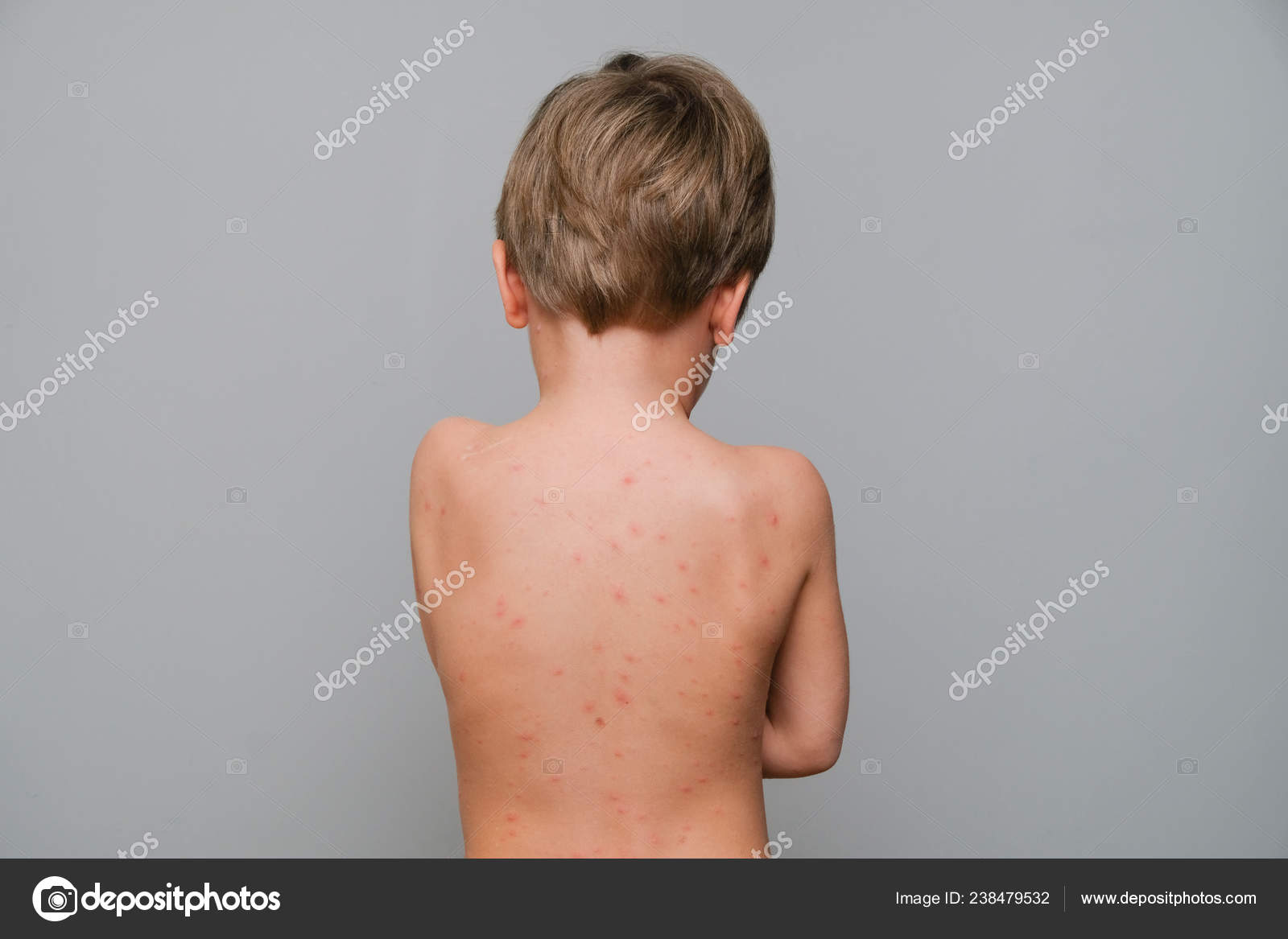 Closeup of back and neck full of blisters,scar and rash caused by ...