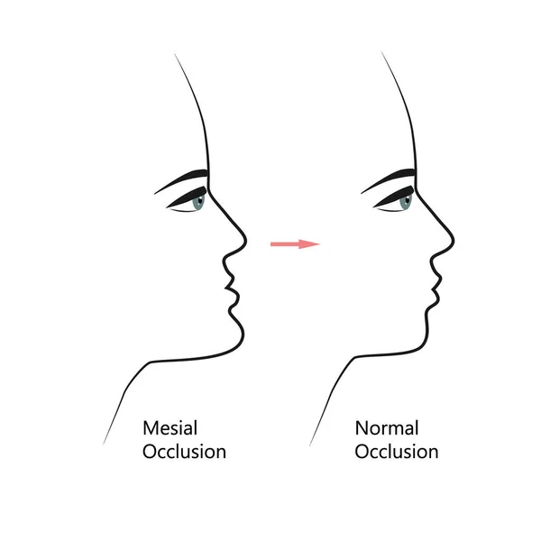Guy with Distal, Normal, and Mesial bite profile, vector illustration ...
