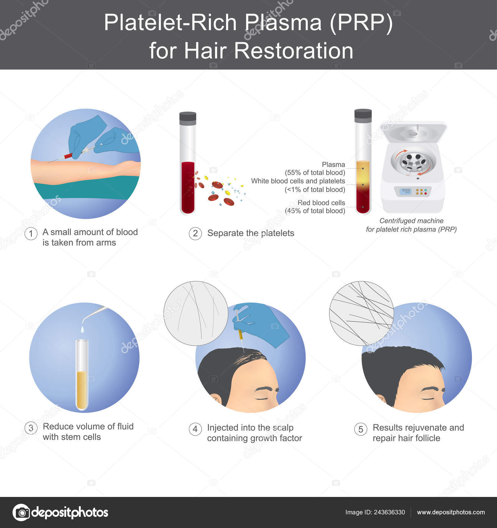 Stimulation Hair Growth Using Blood Service Recipients Process ...