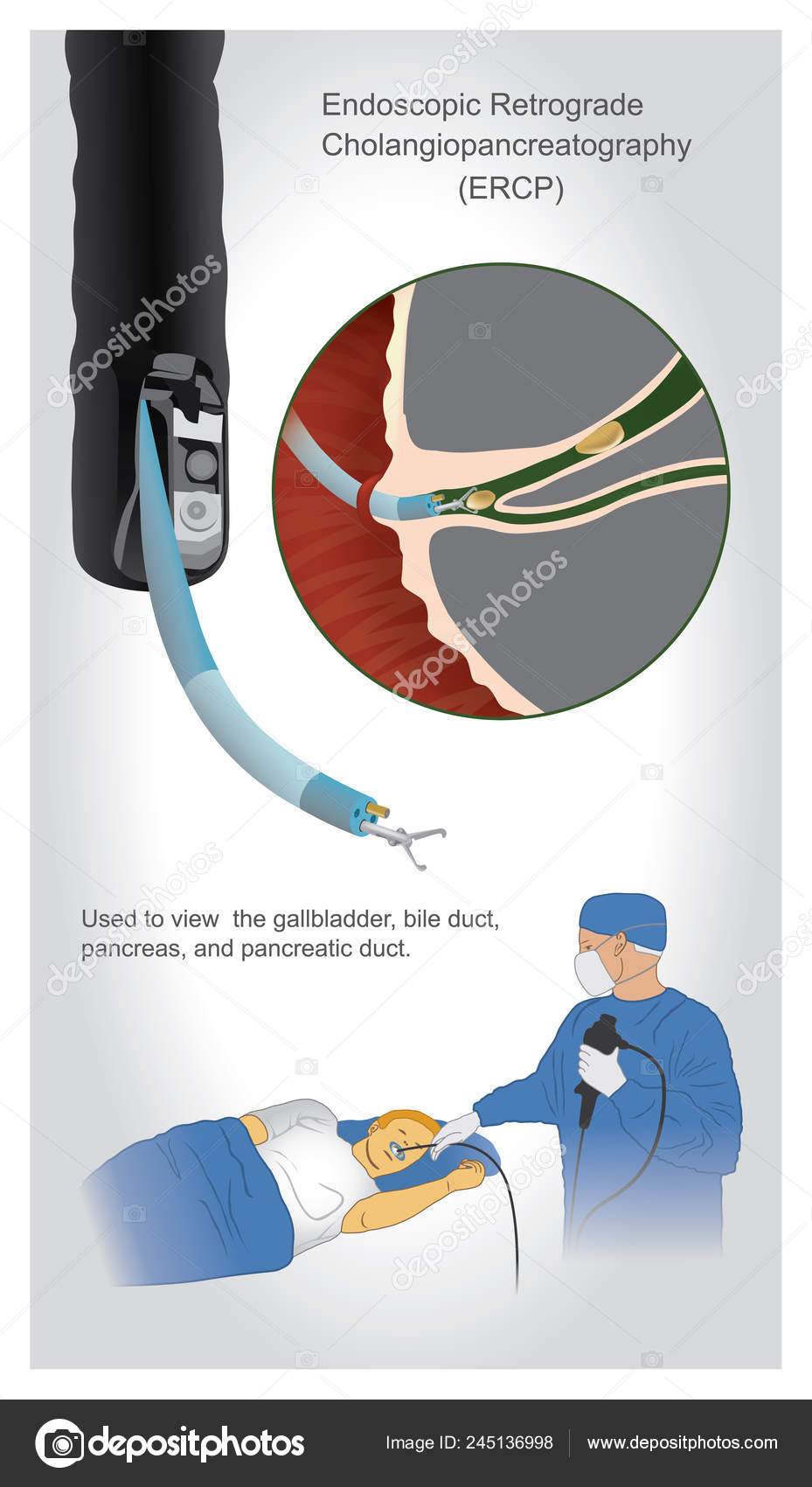Colangiopancreatografía Retrógrada Endoscópica