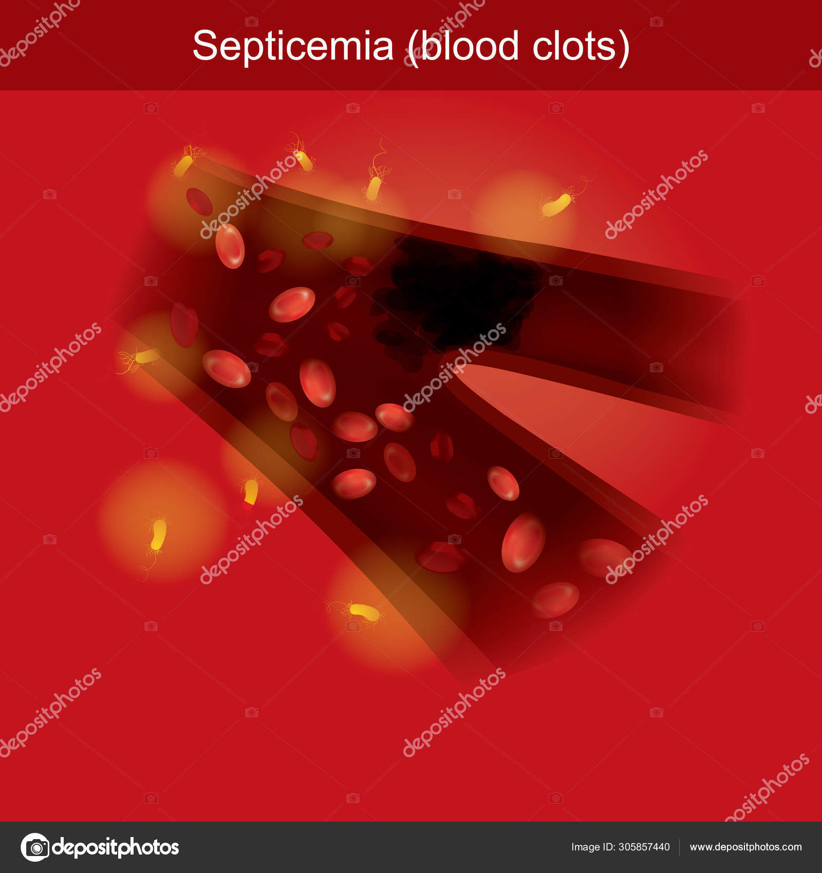 Septicemia infographic 3d Illustration. Stock Vector Image by ...