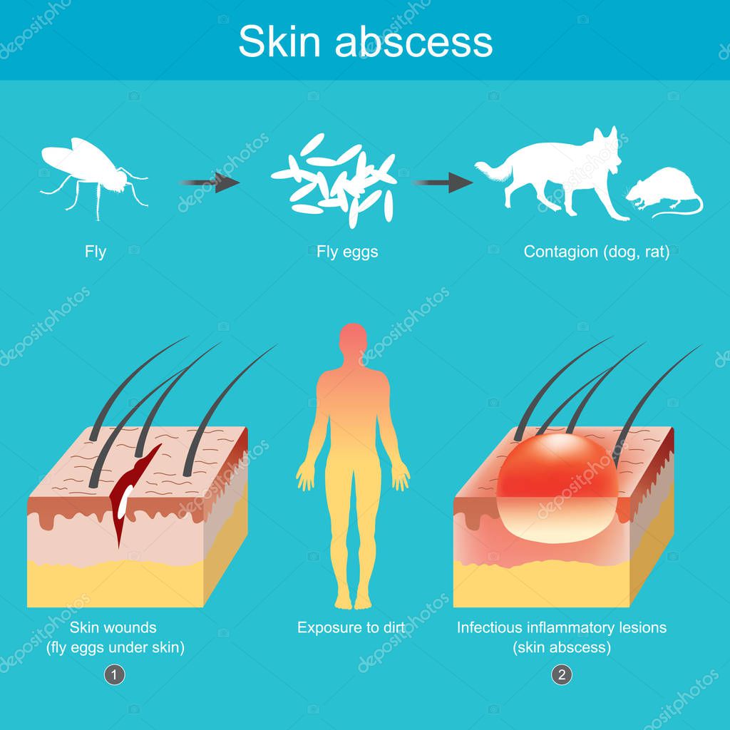 Absceso cutáneo . Vector de Stock de ©pattarawit 305863372