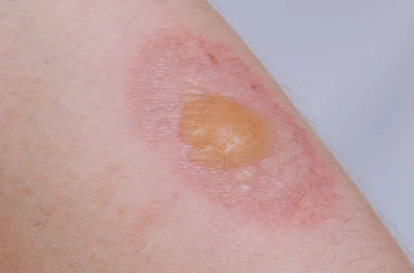 Scald burn Stock Photos, Royalty Free Scald burn Images | Depositphotos