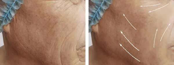 Essai de pli cutané Stock Photos, Royalty Free Essai de pli cutané ...