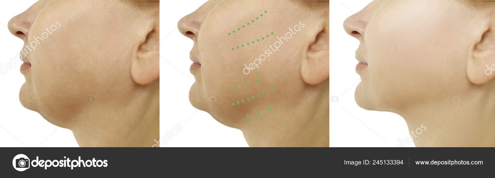 Woman Double Chin Procedures Oval Retouching Stock Photo by ©TanyaLovus ...