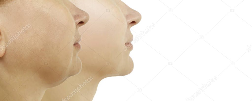 barbilla doble mujer antes y después de los procedimientos, retoque ...