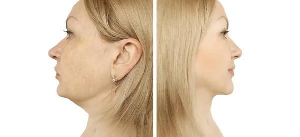 Female Double Chin Procedures Stock Photo by ©TanyaLovus 251641918