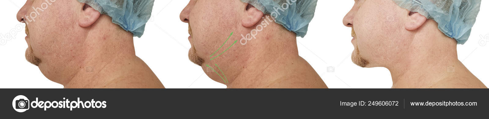 Male Double Chin Correction Procedures — Stock Photo © TanyaLovus ...