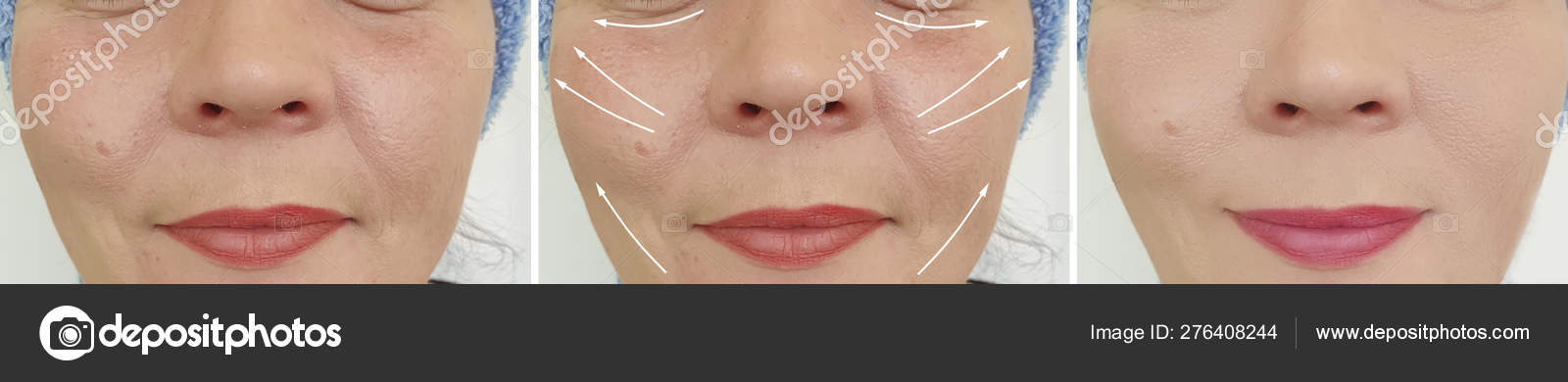 Woman Face Wrinkles Correction — Stock Photo © TanyaLovus #276408244