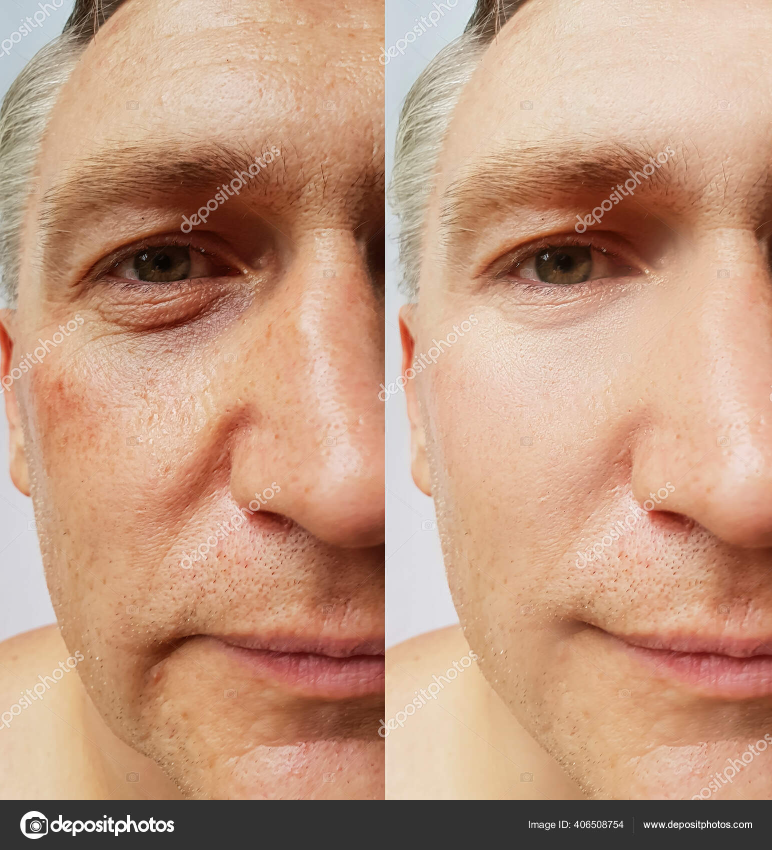 Man Face Wrinkles Treatment Stock Photo by ©TanyaLovus 406508754