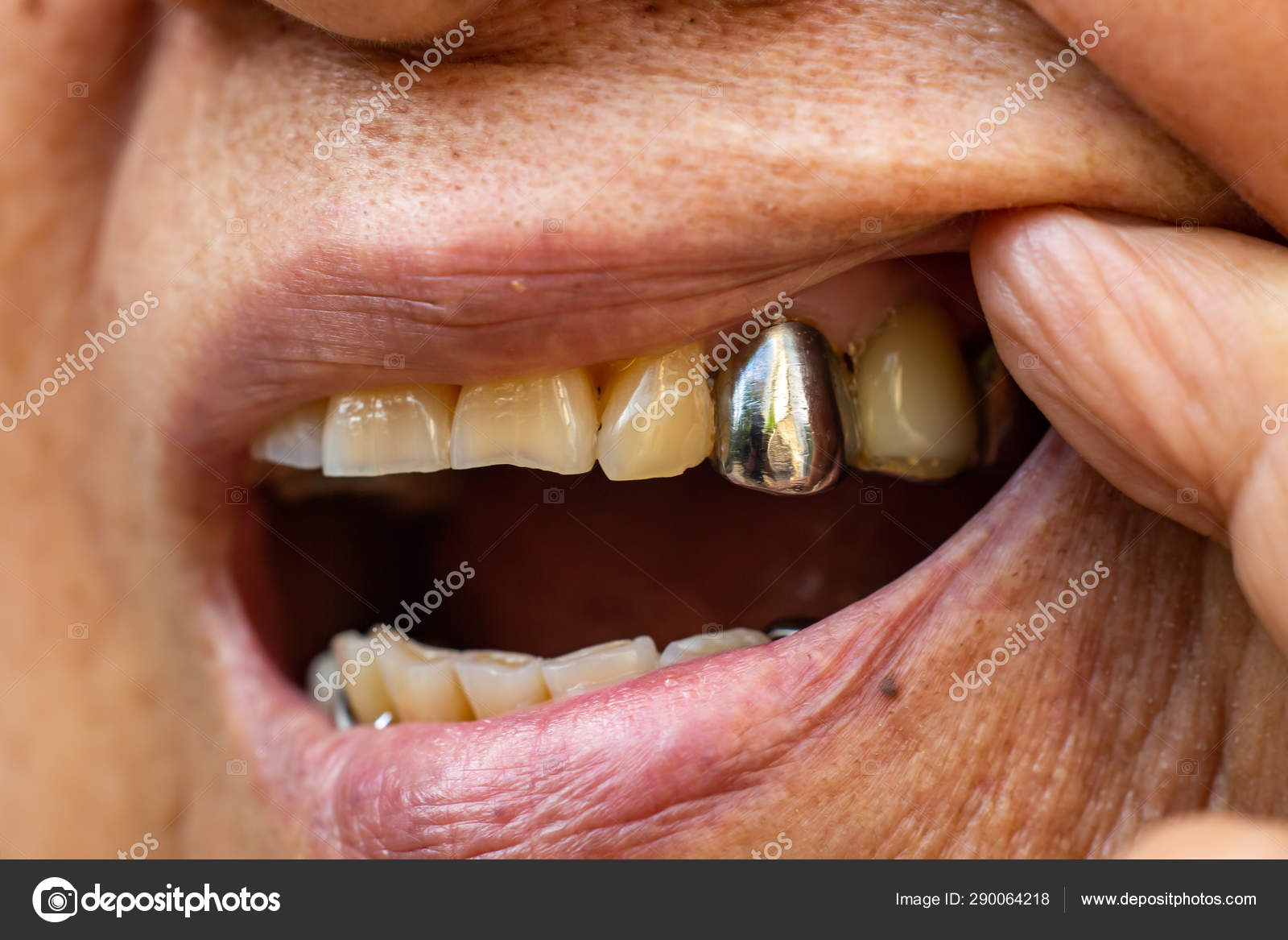 Silver metal Artificial teeth in the mouth of senior woman, Stomatology ...