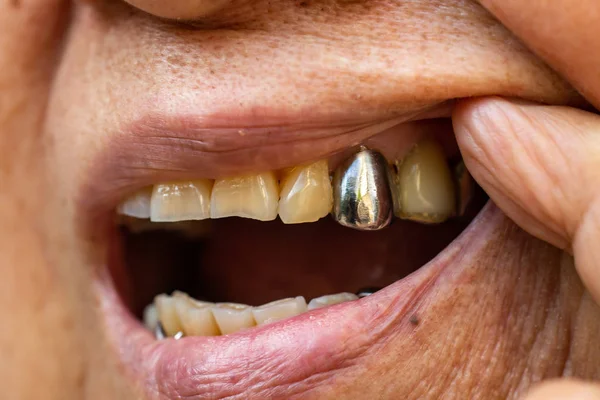 Silver teeth Images - Search Images on Everypixel