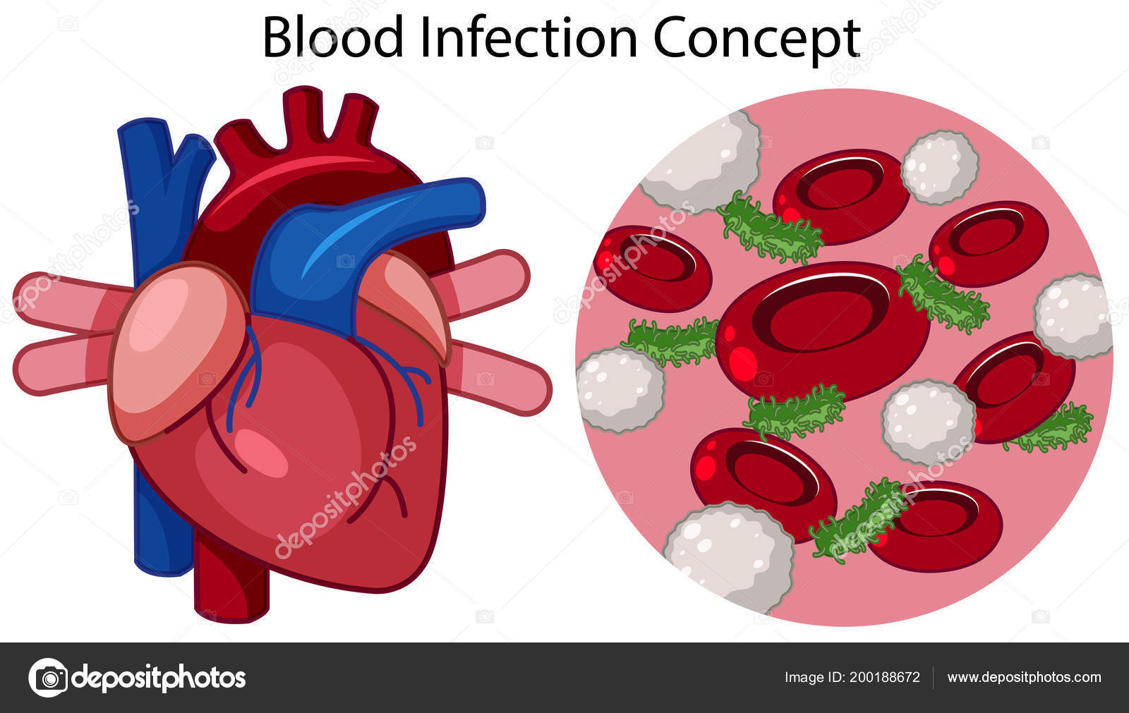 Vector Blood Infection Concept Illustration Stock Illustration by ...