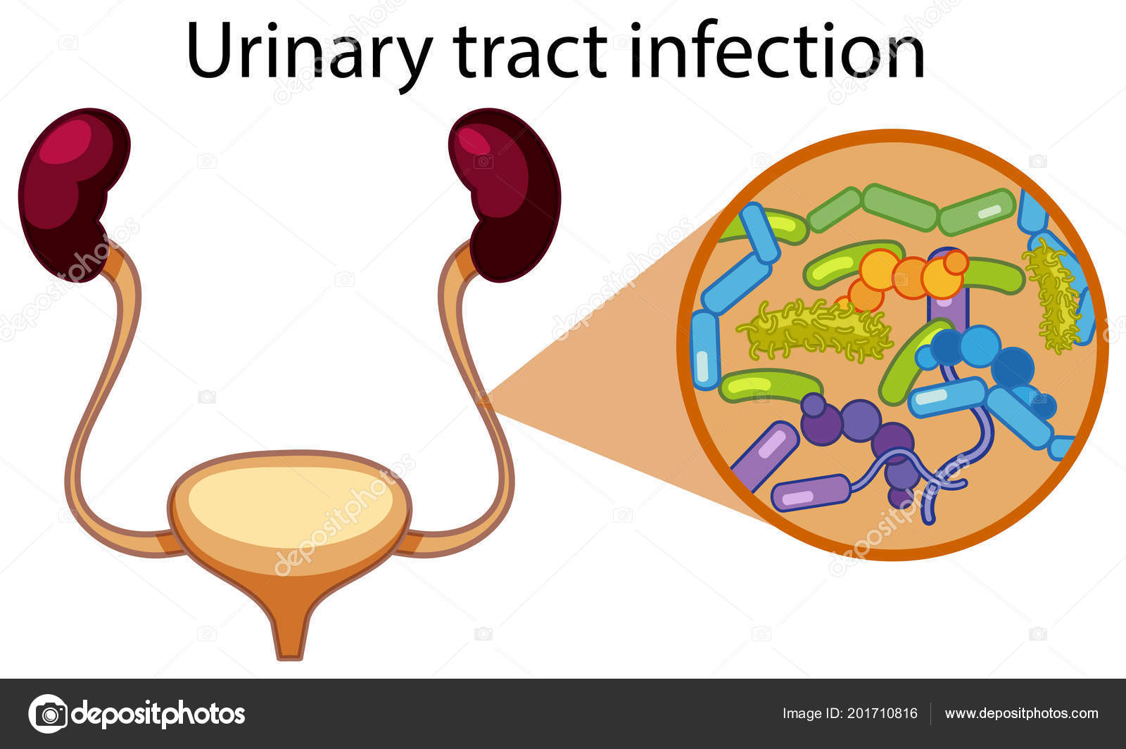 Clip Art Urinary Tract Infection