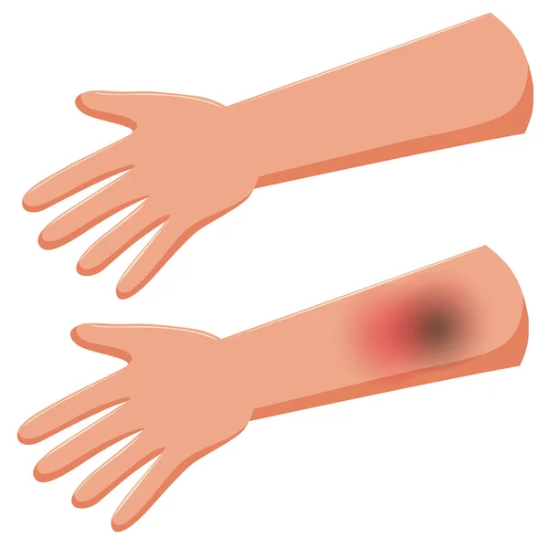 Arm Injury Clipart